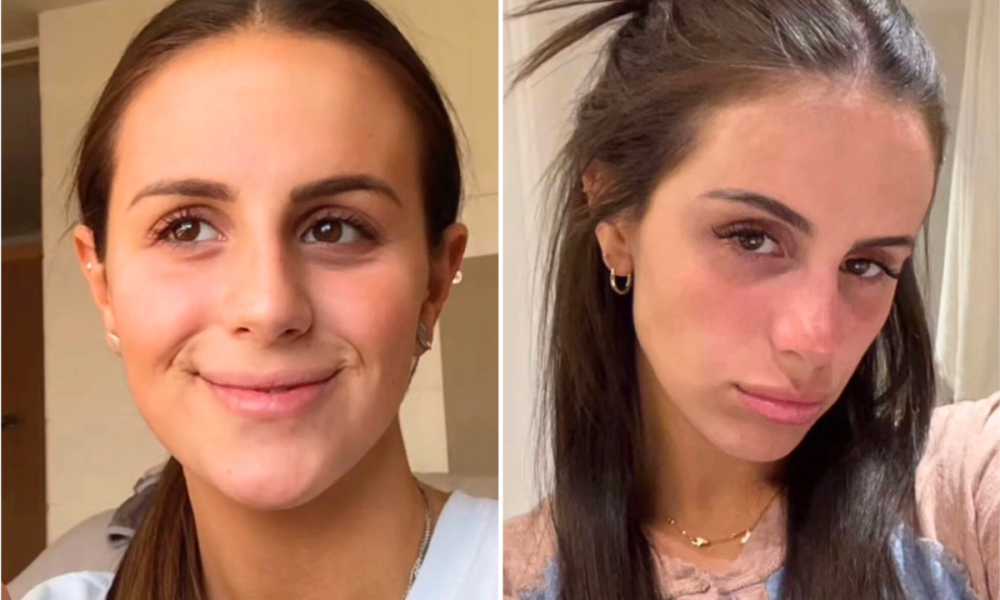 Gua Sha Plastic Surgery Before And After Celebrity Jihad